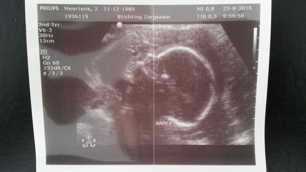 11e echo – Terneuzen – Tweeling